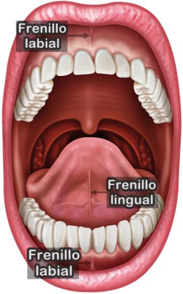 Frenectomia: Indicaciones y Precios en Lima Perú| Solución Dental