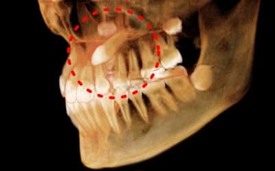 Dientes retenidos: Soluciones | Solución Dental ® Lima - Perú