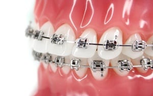 Brackets: Guía 2023 para elegirlos, Lima Perú | Solución Dental