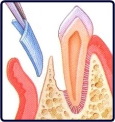 Regeneraci n Tisular Guiada Soluci n Dental Lima Per 