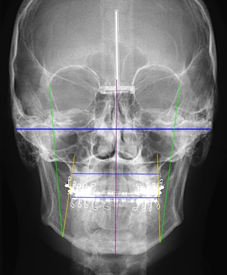 Radiografía Cefalométrica o de Perfil ortodoncia ¿Para qué sirve?